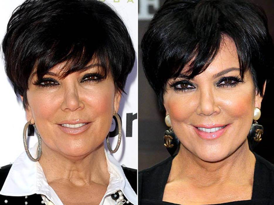 Kris Jenner’s Before and After Plastic Surgery Photos Show She Looks ... Kris Jenner’s Before and After Plastic Surgery Photos Show She Looks ...